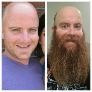 45 Amazing Beard Before and After Transformation Photos