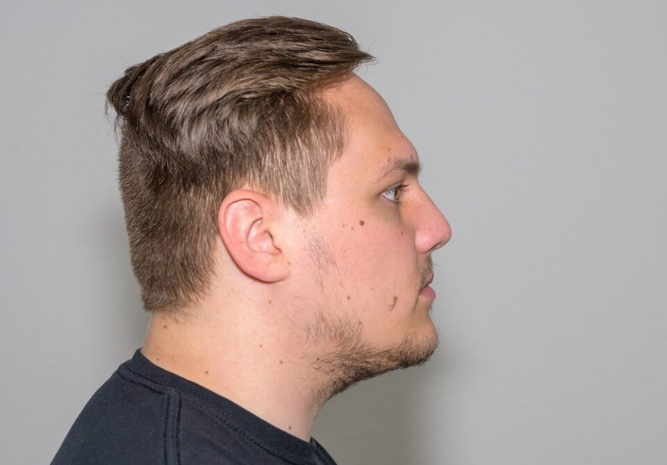 Peach Fuzz vs Terminal Beard Hair Explained